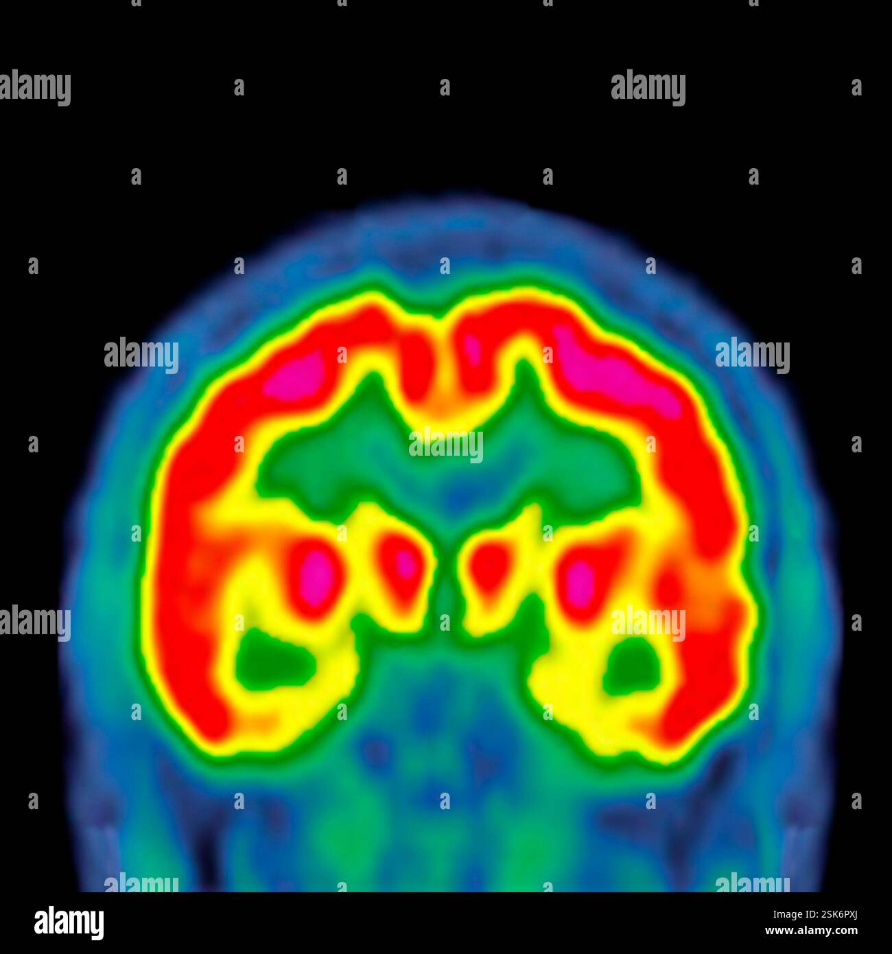 Normal brain activity. Coloured positron emission tomography (PET) scan ...
