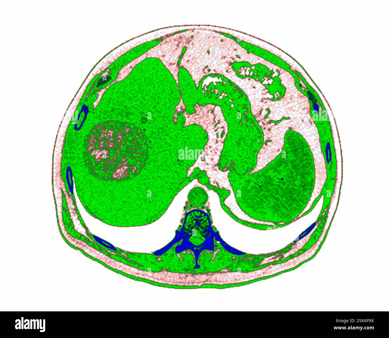 Liver cancer. Coloured computed tomography (CT) scan of an axial section through the abdomen of ...