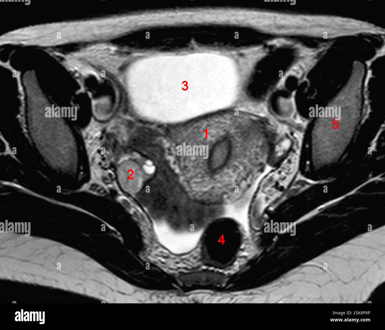 Normal female pelvis. Magnetic resonance imaging scan (MRI) of an axial ...