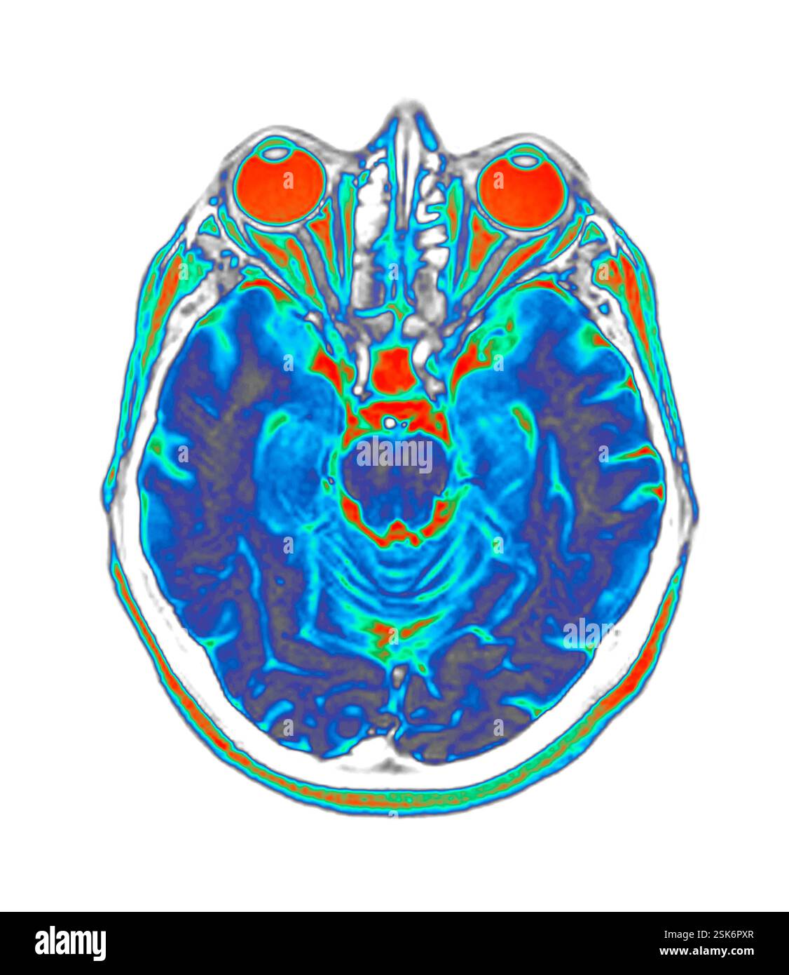 Normal brain. Coloured magnetic resonance imaging scan (MRI) of a section through a head ...