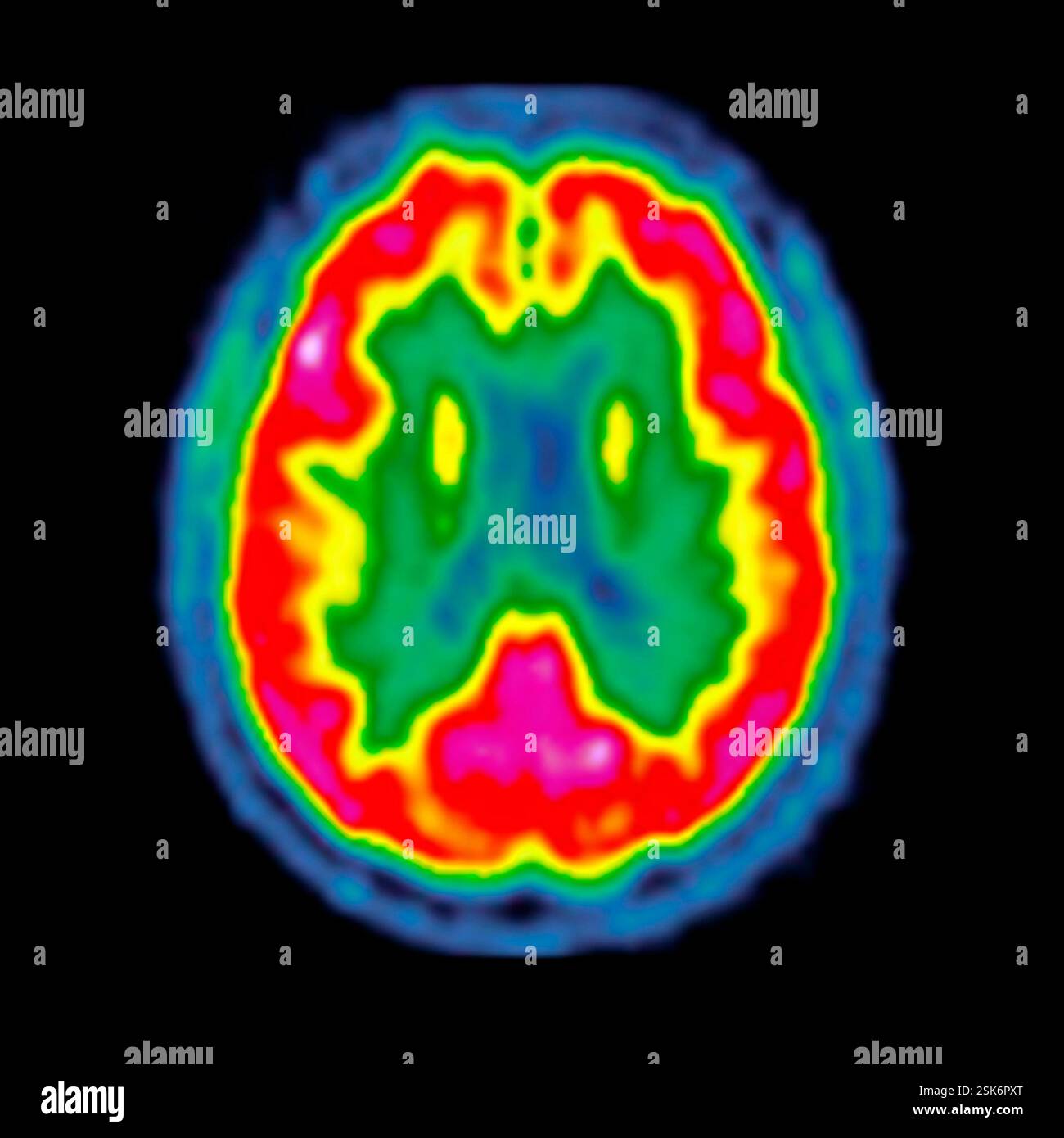 Normal brain activity. Coloured positron emission tomography (PET) scan of an axial section ...