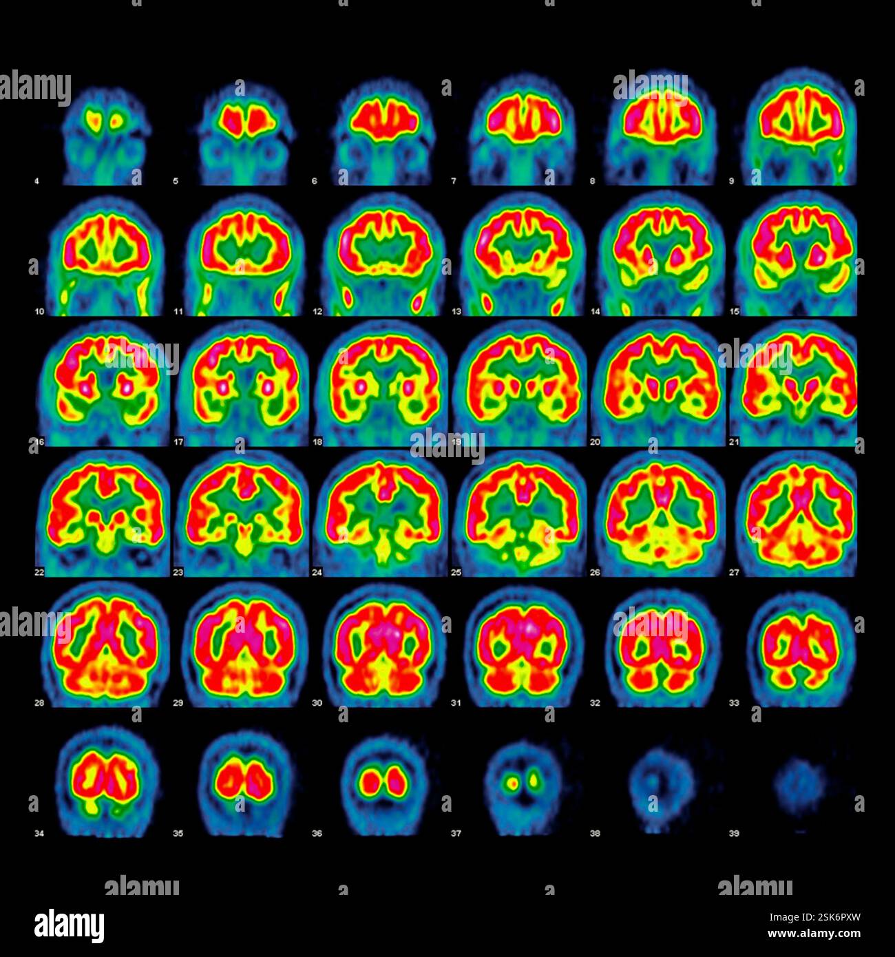 Normal brain activity. Coloured positron emission tomography (PET ...