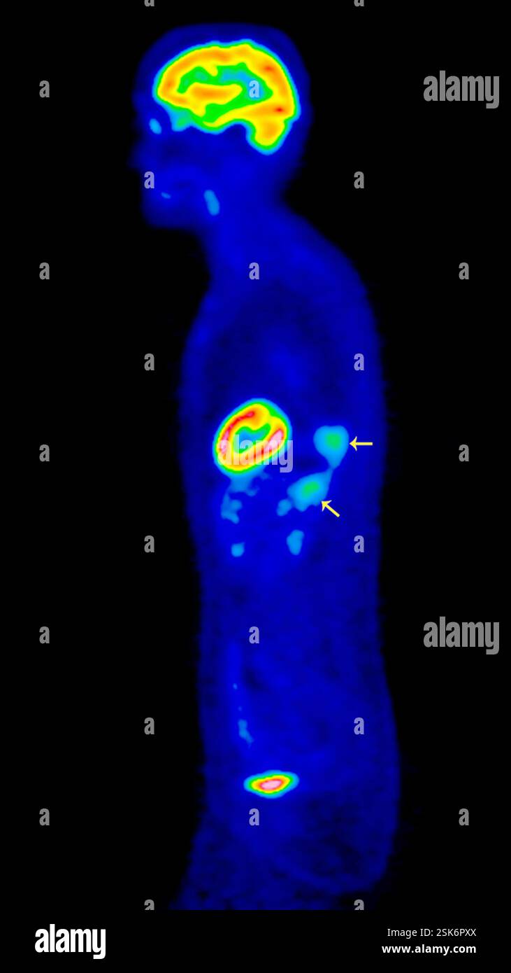 Lung cancer. Coloured combined positron emission tomography (PET) and computed tomography (CT ...