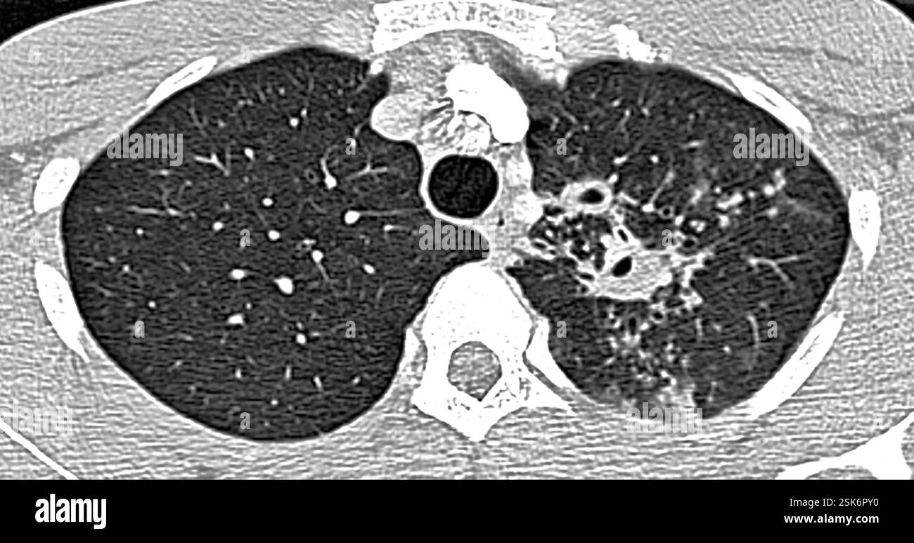 Tuberculosis of the lung. Computed tomography (CT) scan of an axial section through the chest of ...