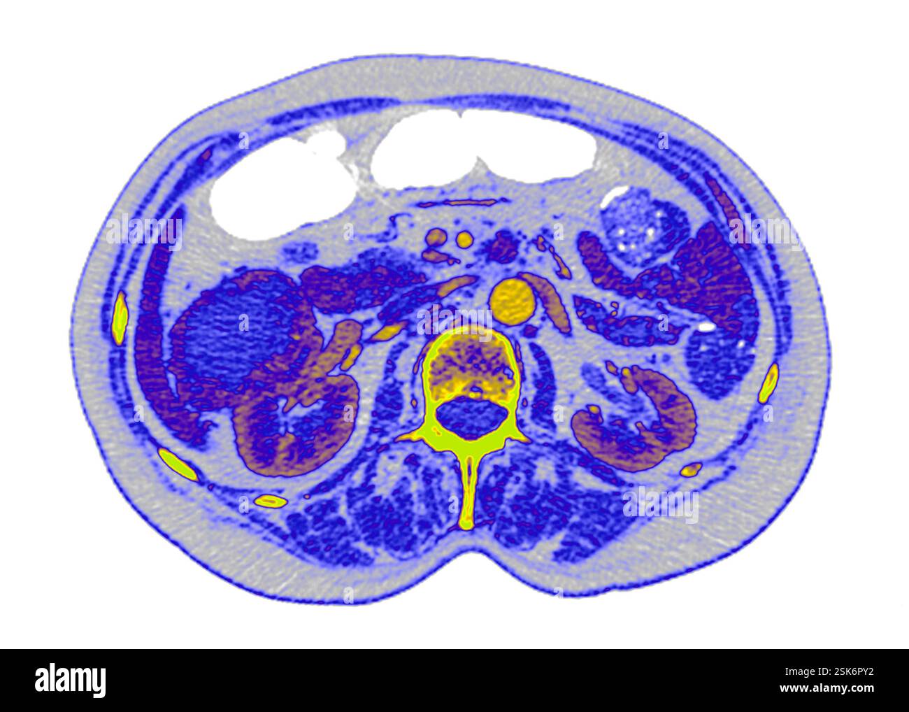 Kidney cancer. Coloured computed tomography (CT) scan of an axial section through the abdomen of ...