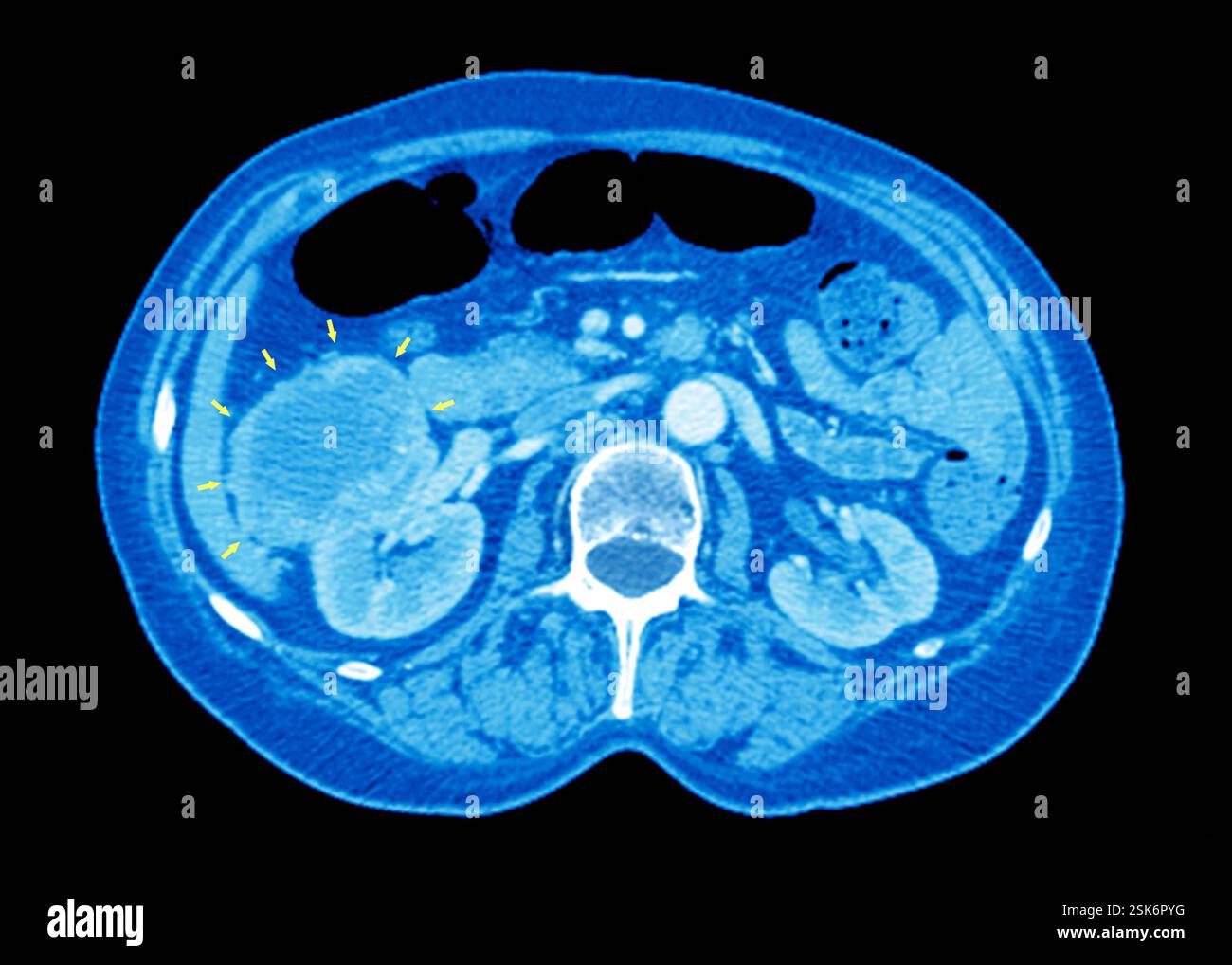 Kidney cancer. Coloured computed tomography (CT) scan of an axial section through the abdomen of ...