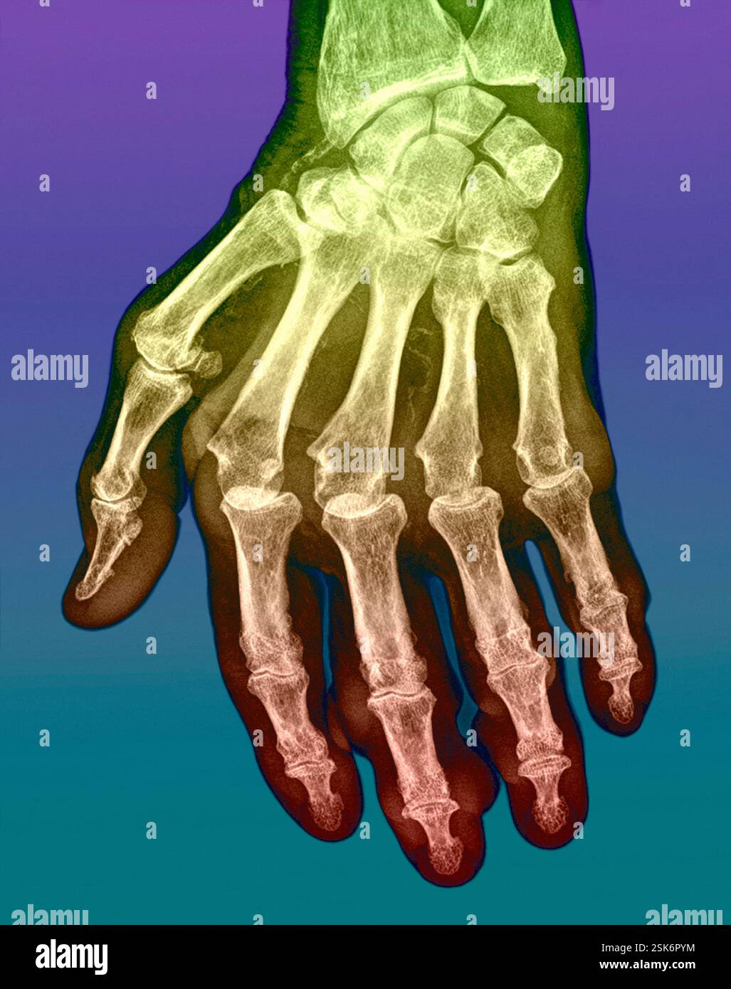 Arthritic hand. X-ray of a section through the left hand of a 77-year ...