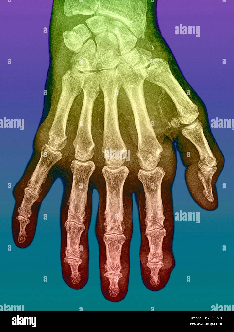 Arthritic hand. Coloured X-ray of a section through the right hand of a ...