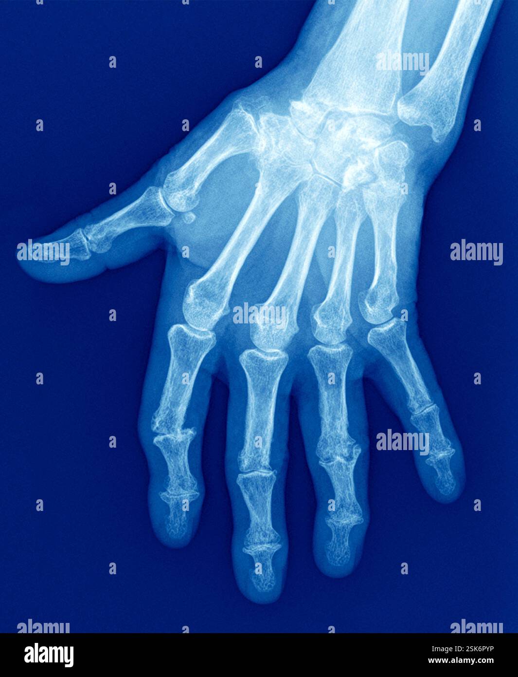 Arthritic hand. X-ray of a section through the left hand of a 52-year ...
