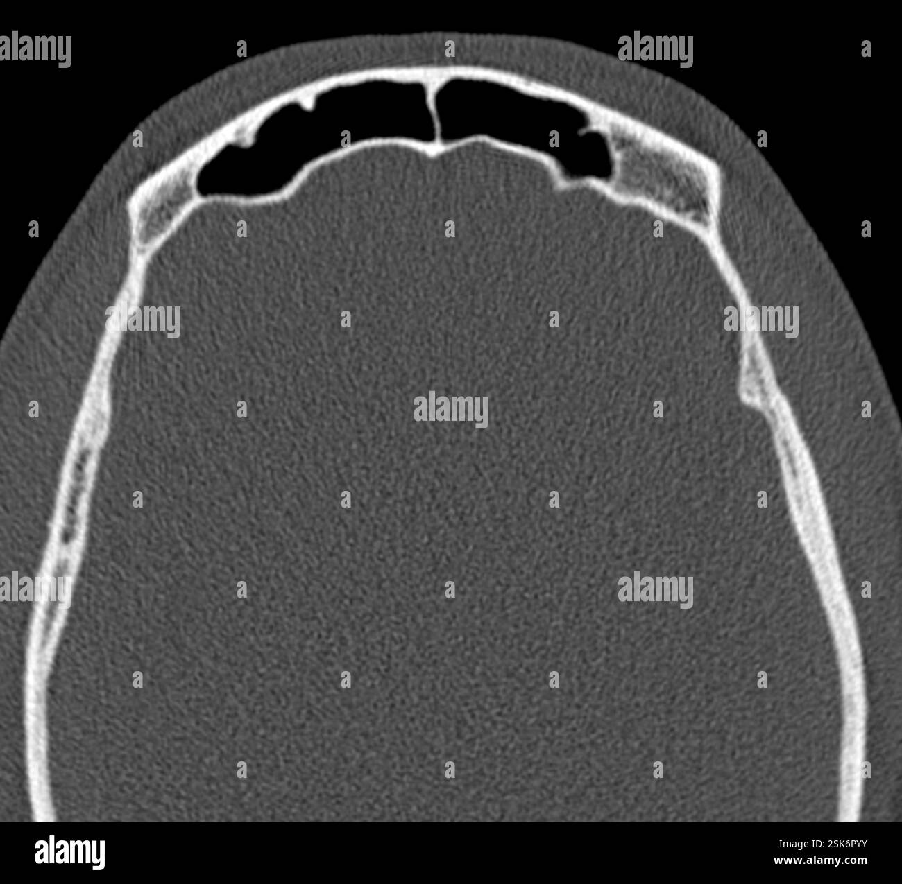 Normal frontal sinus. Computed tomography (CT) scan of a section ...