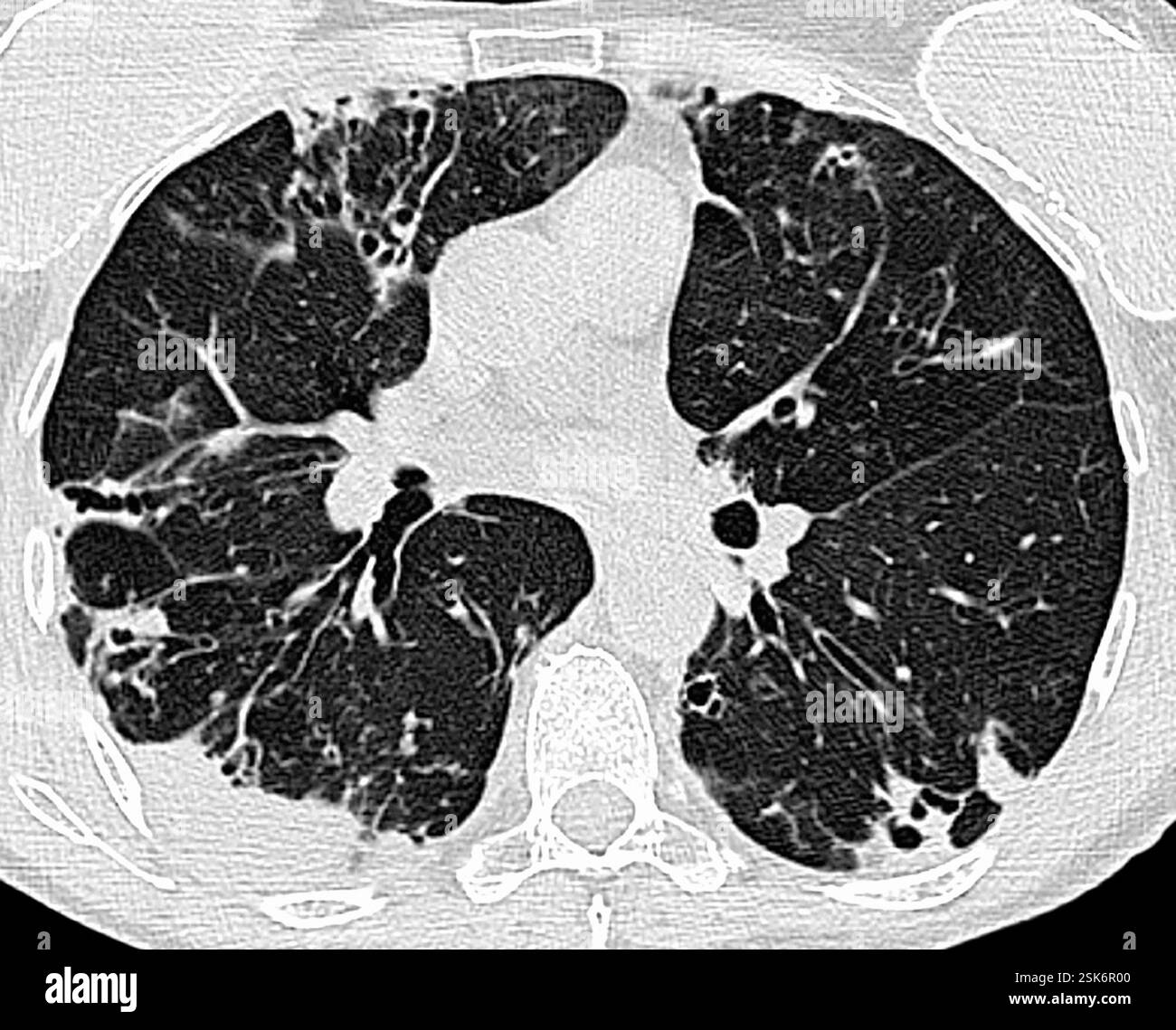 Atypical mycobacteria lung infection. Computed tomography (CT) scan of an axial section through ...