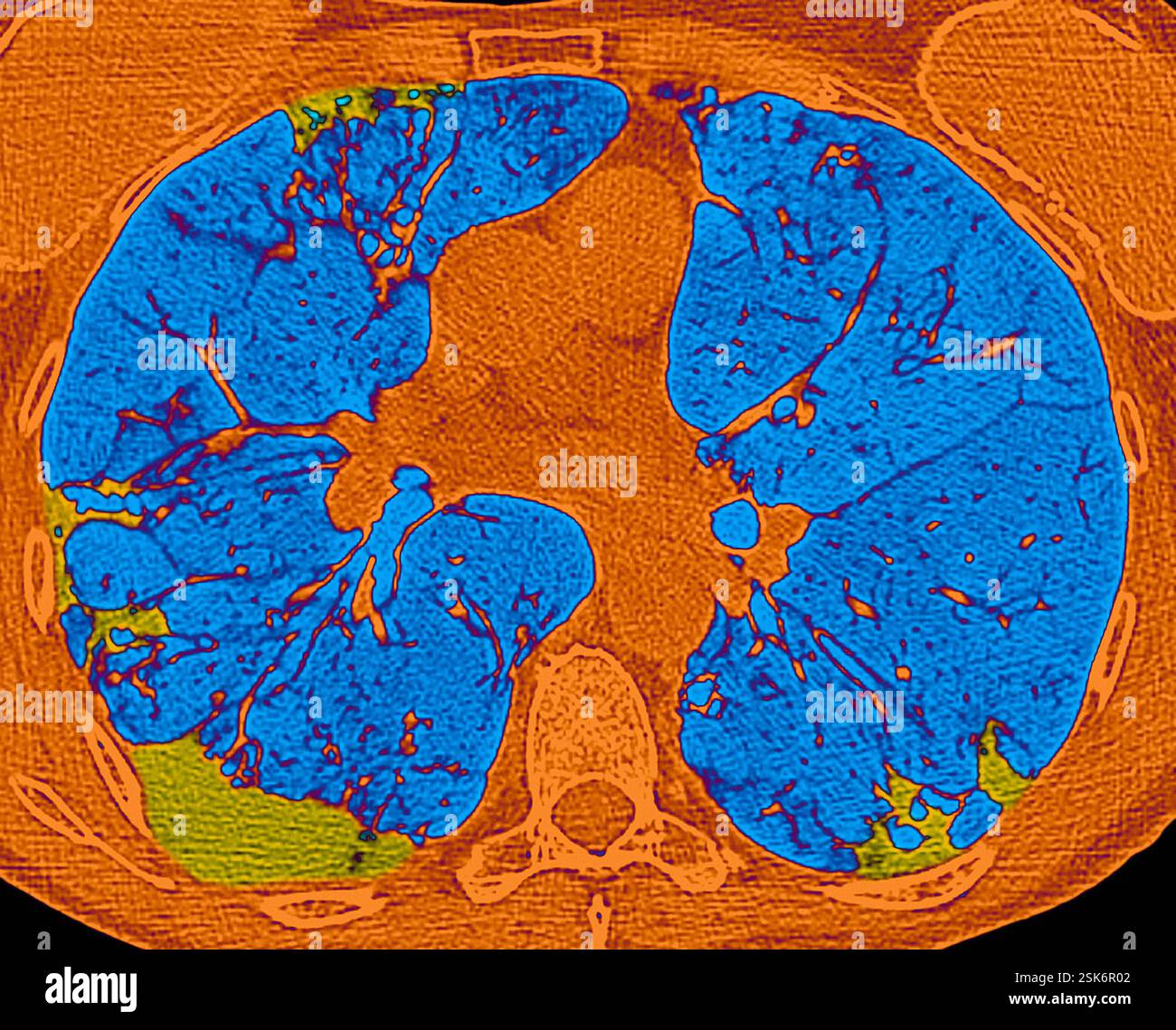 Atypical mycobacteria lung infection. Computed tomography (CT) scan of an axial section through ...