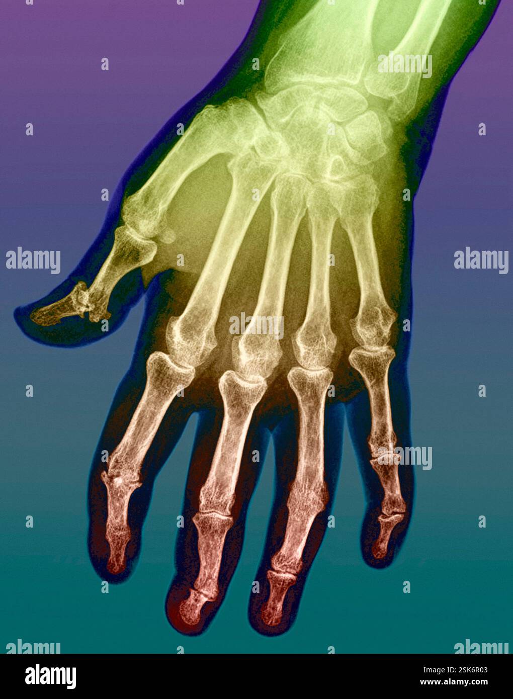 Arthritic hand. Coloured X-ray of a section through the left hand of a ...