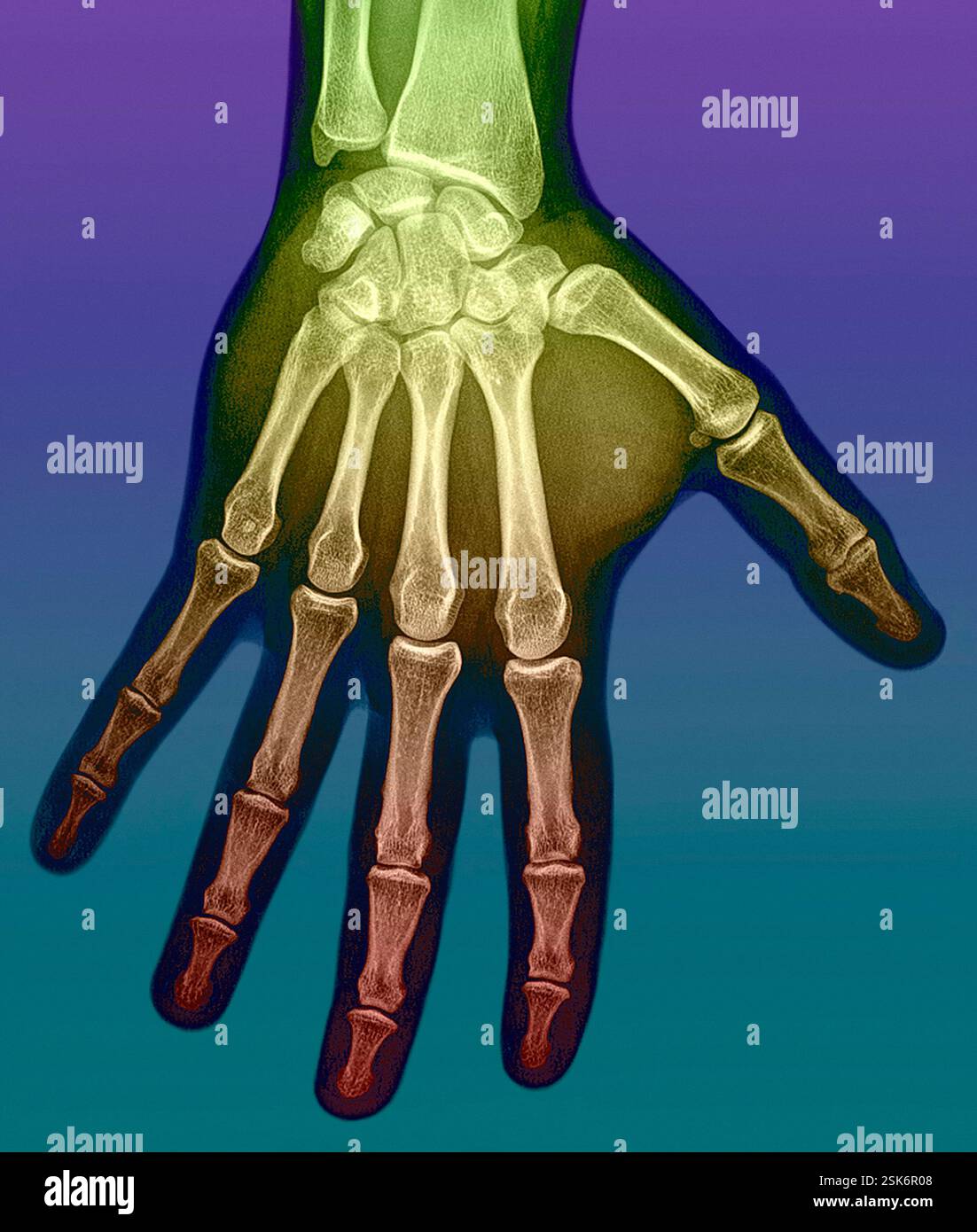 Normal hand. Coloured X-ray of the healthy right hand of a 30-year-old ...