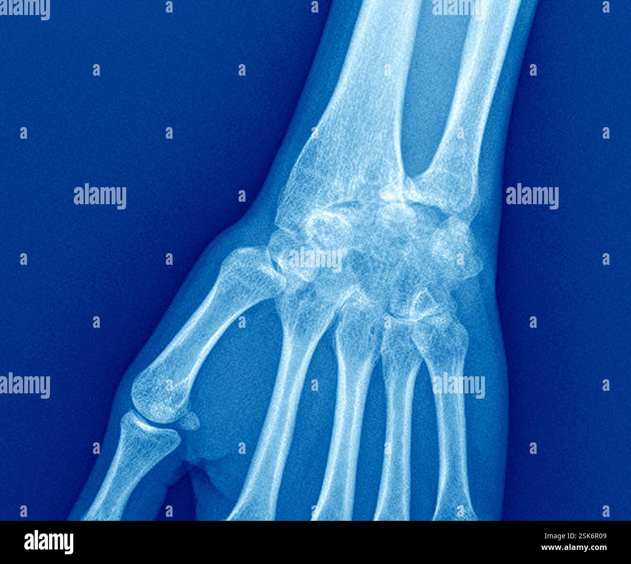 Fused bones in arthritic wrist. X-ray of a section through the left ...