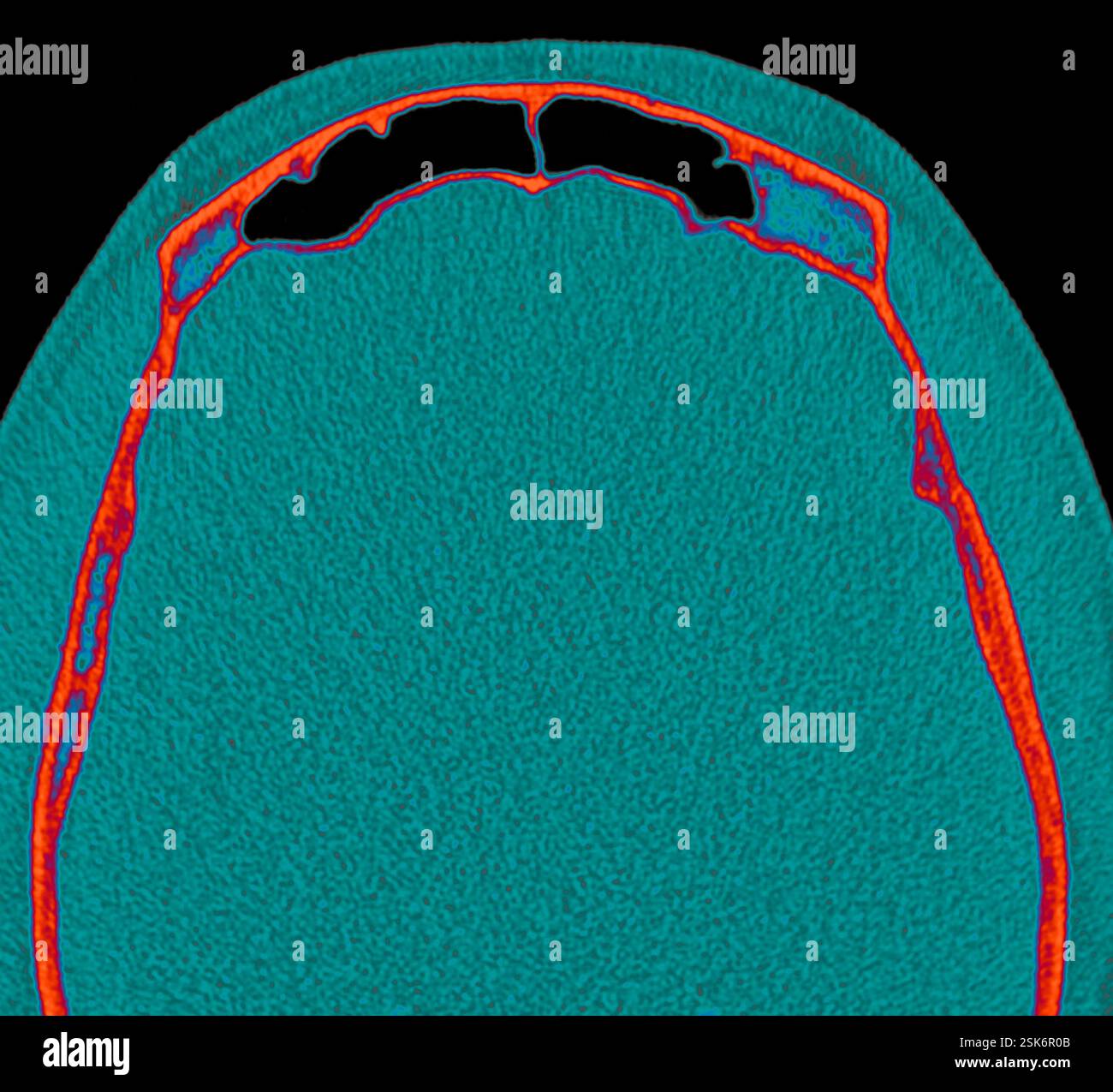 Normal frontal sinus. Coloured computed tomography (CT) scan of a ...