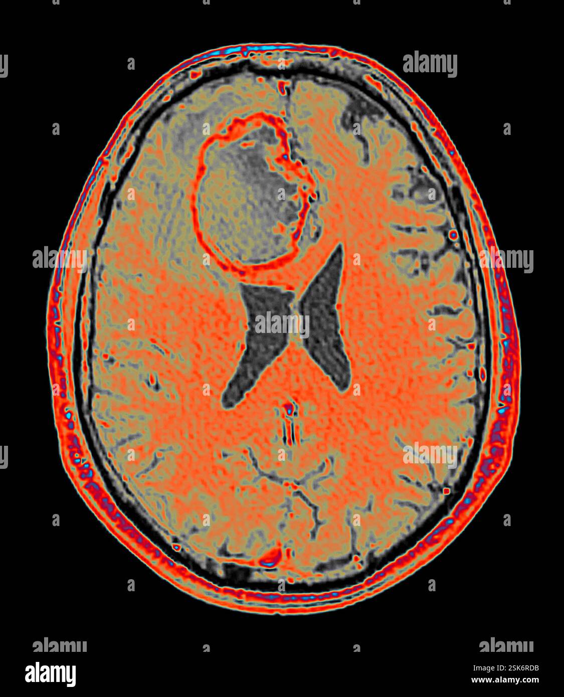 Brain cancer. Coloured T1-weighted magnetic resonance imaging scan (MRI ...