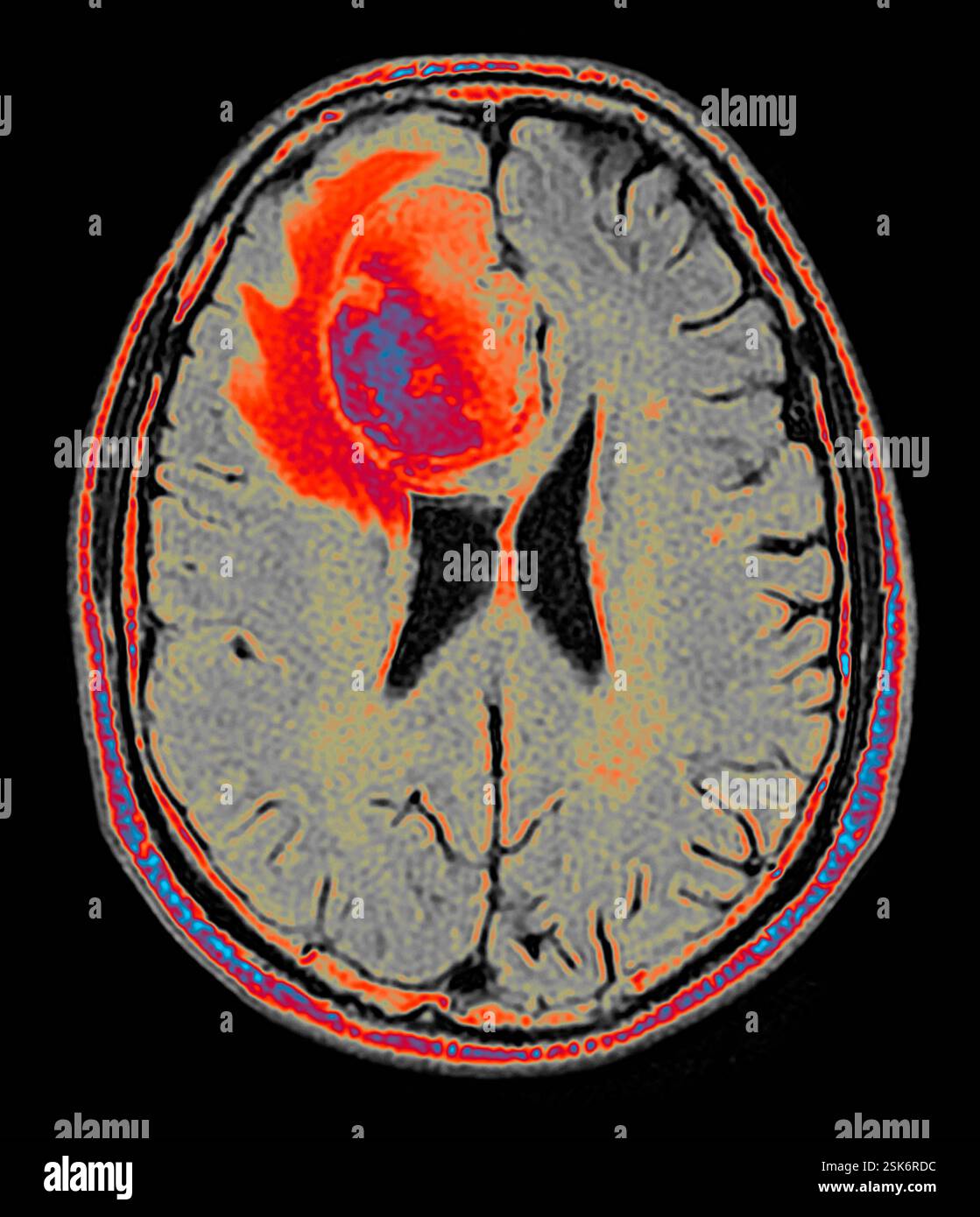 Brain cancer. Coloured FLAIR (fluid-attenuated inversion recovery) magnetic resonance imaging ...