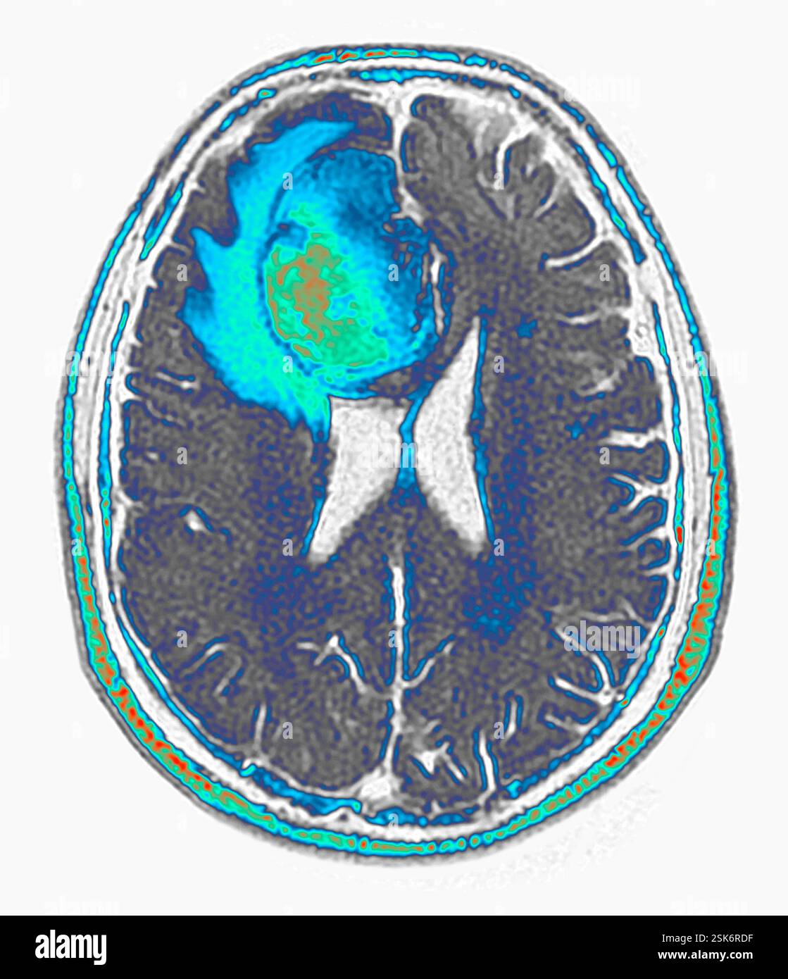 Brain cancer. Coloured FLAIR (fluid-attenuated inversion recovery) magnetic resonance imaging ...
