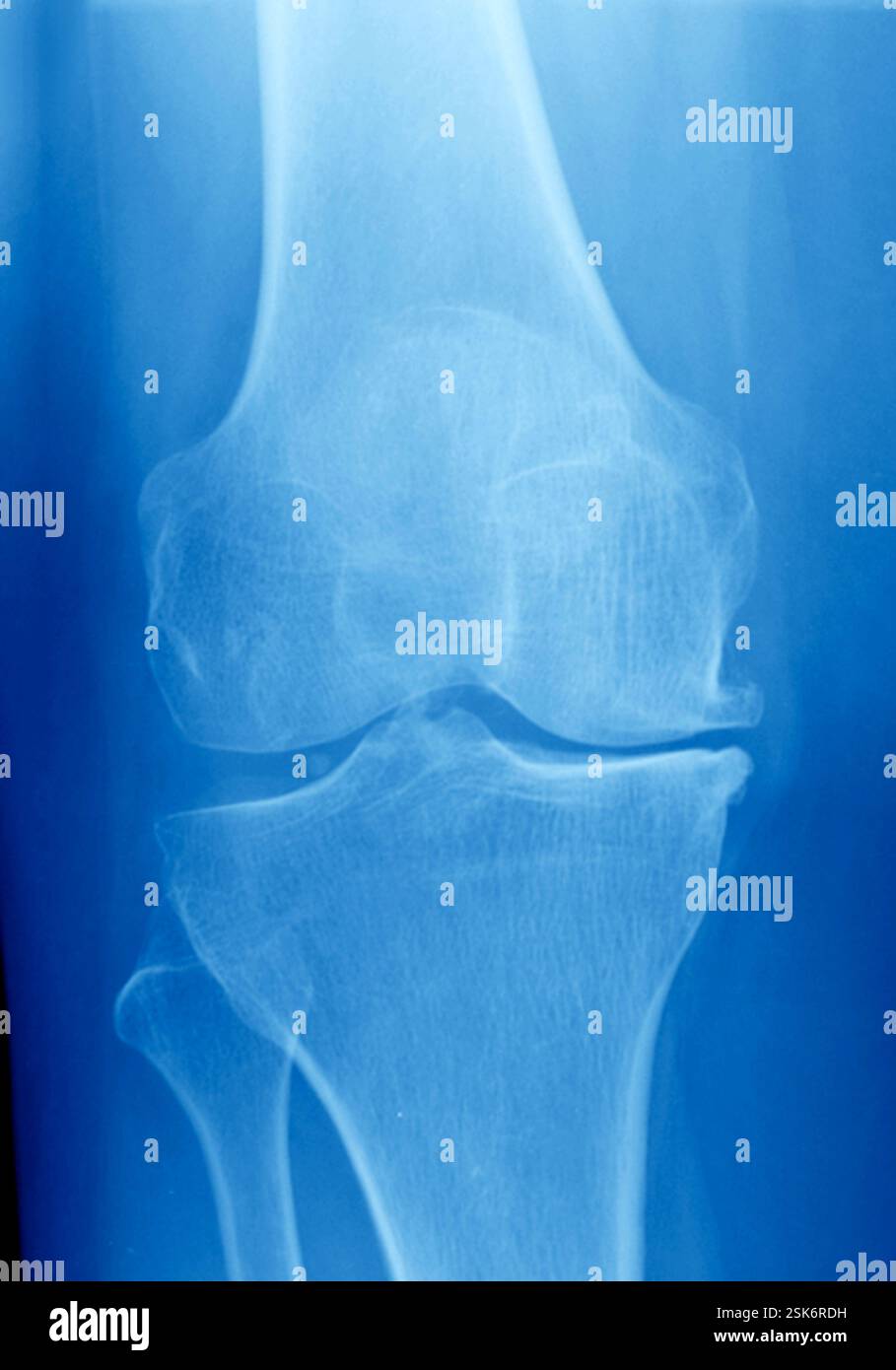 Colpitis caused by Trichomonas vaginalis, colposcopy Stock Photo - Alamy