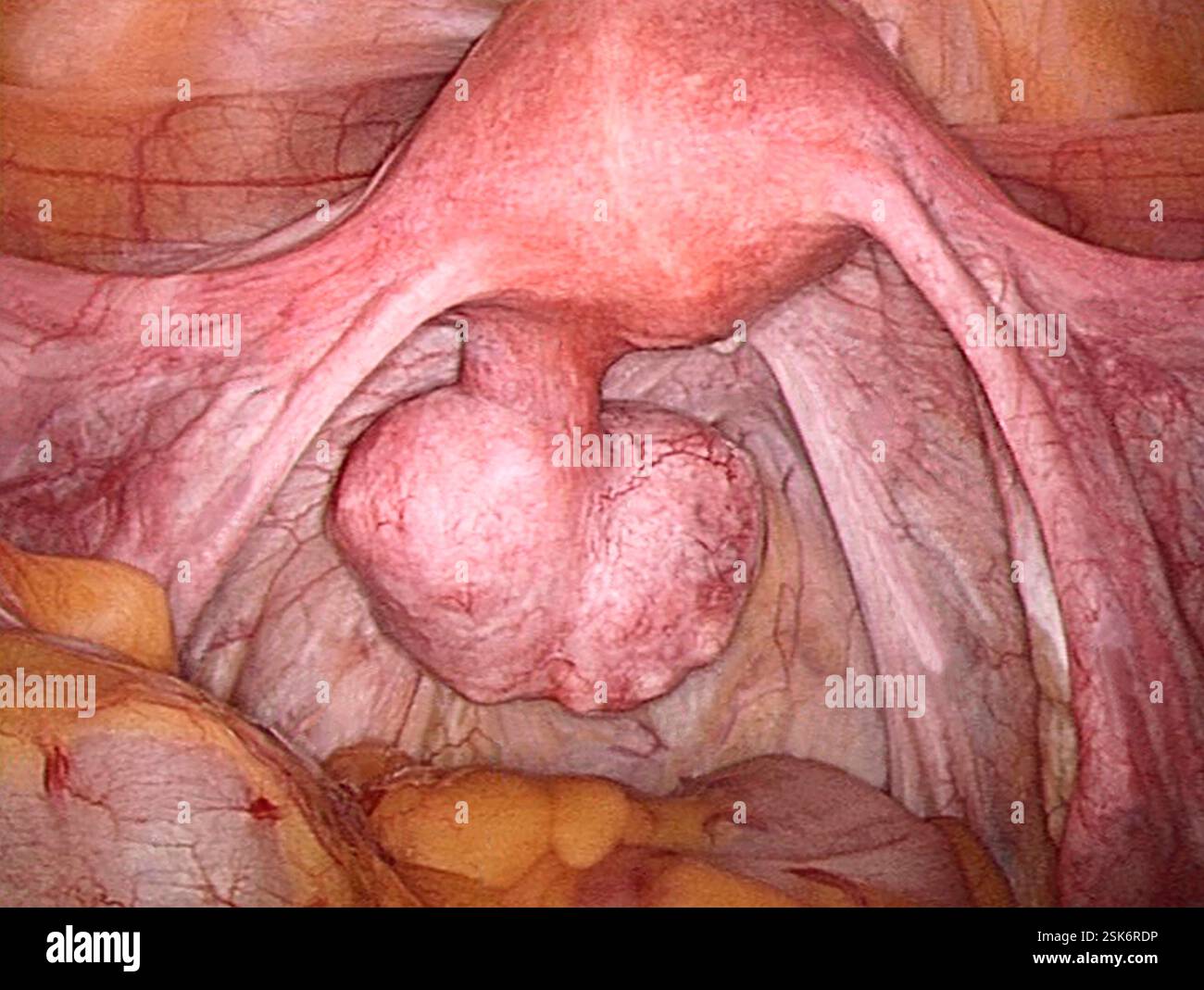 Uterine fibroid. Laparoscopic image of a fibroid (myoma, centre ...