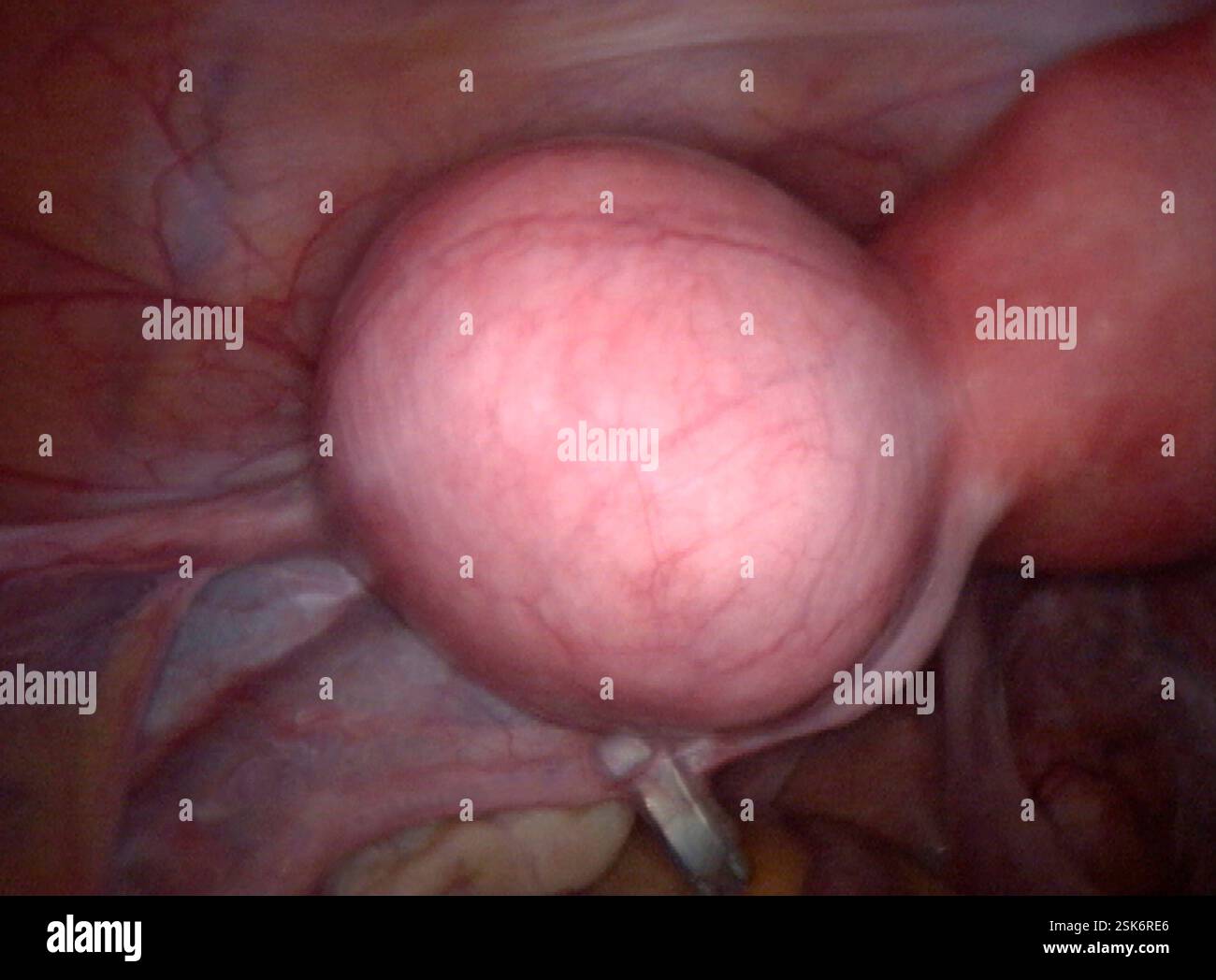 Uterine fibroid. Laparoscopic image of a fibroid (myoma) affecting the ...