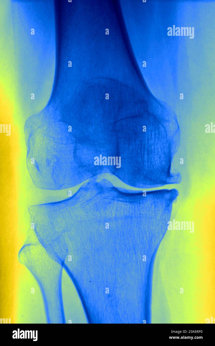 Colpitis caused by Trichomonas vaginalis, colposcopy Stock Photo - Alamy