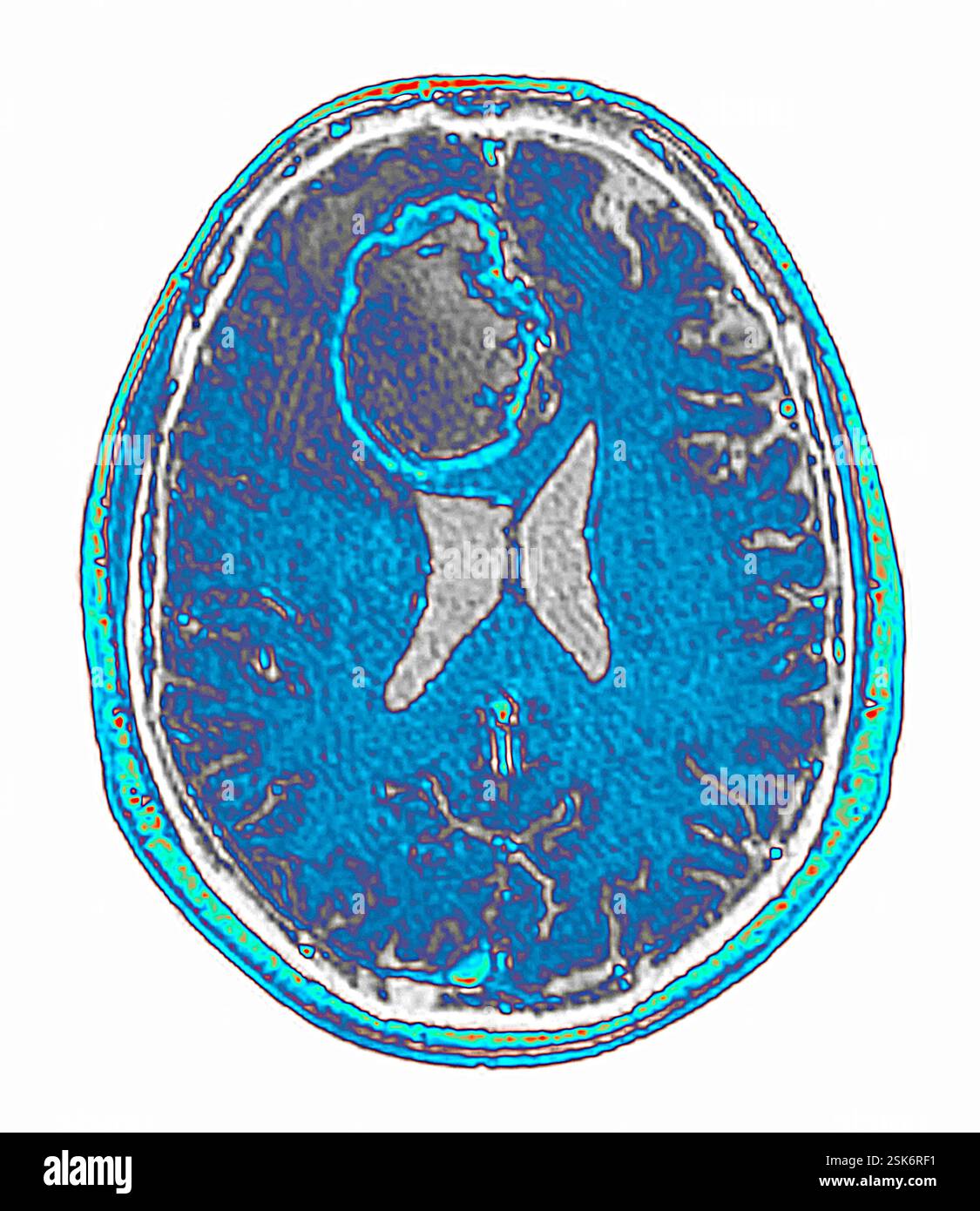 Brain cancer. Coloured T1-weighted magnetic resonance imaging scan (MRI ...