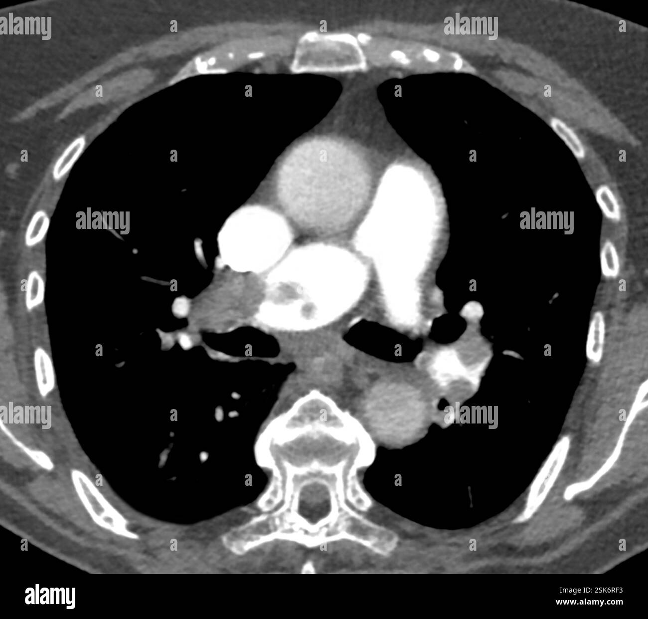 Acute pulmonary embolism. Computed tomography (CT) scan of an axial ...