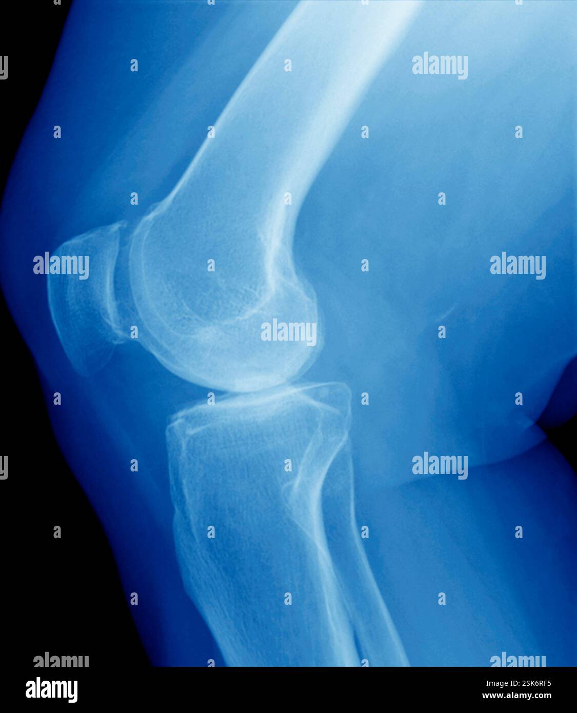 Usual interstitial pneumonia in rheumatoid arthritis, CT sca Stock ...