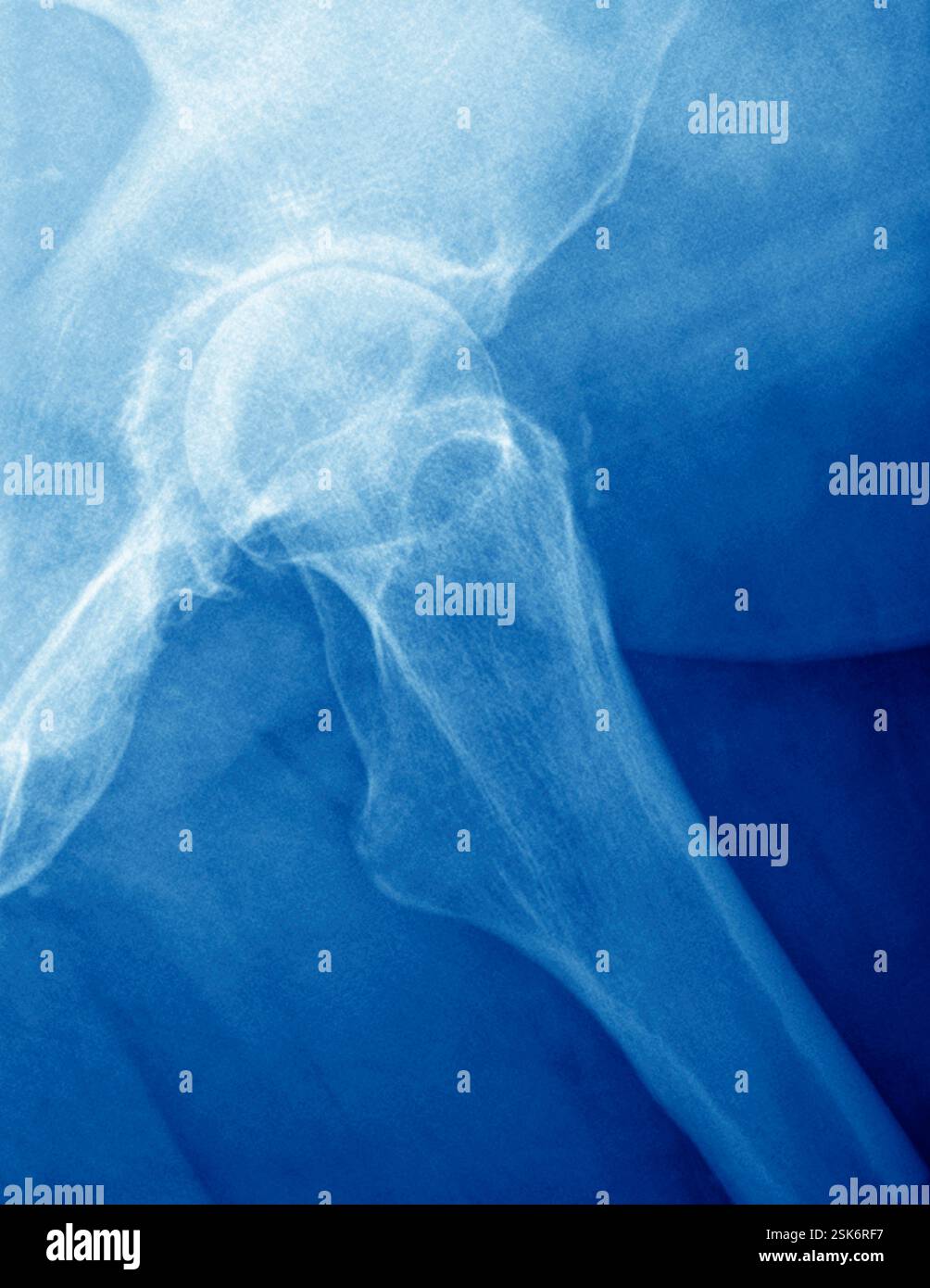 Osteoarthritis of the hip. Coloured X-ray of a section through the left ...