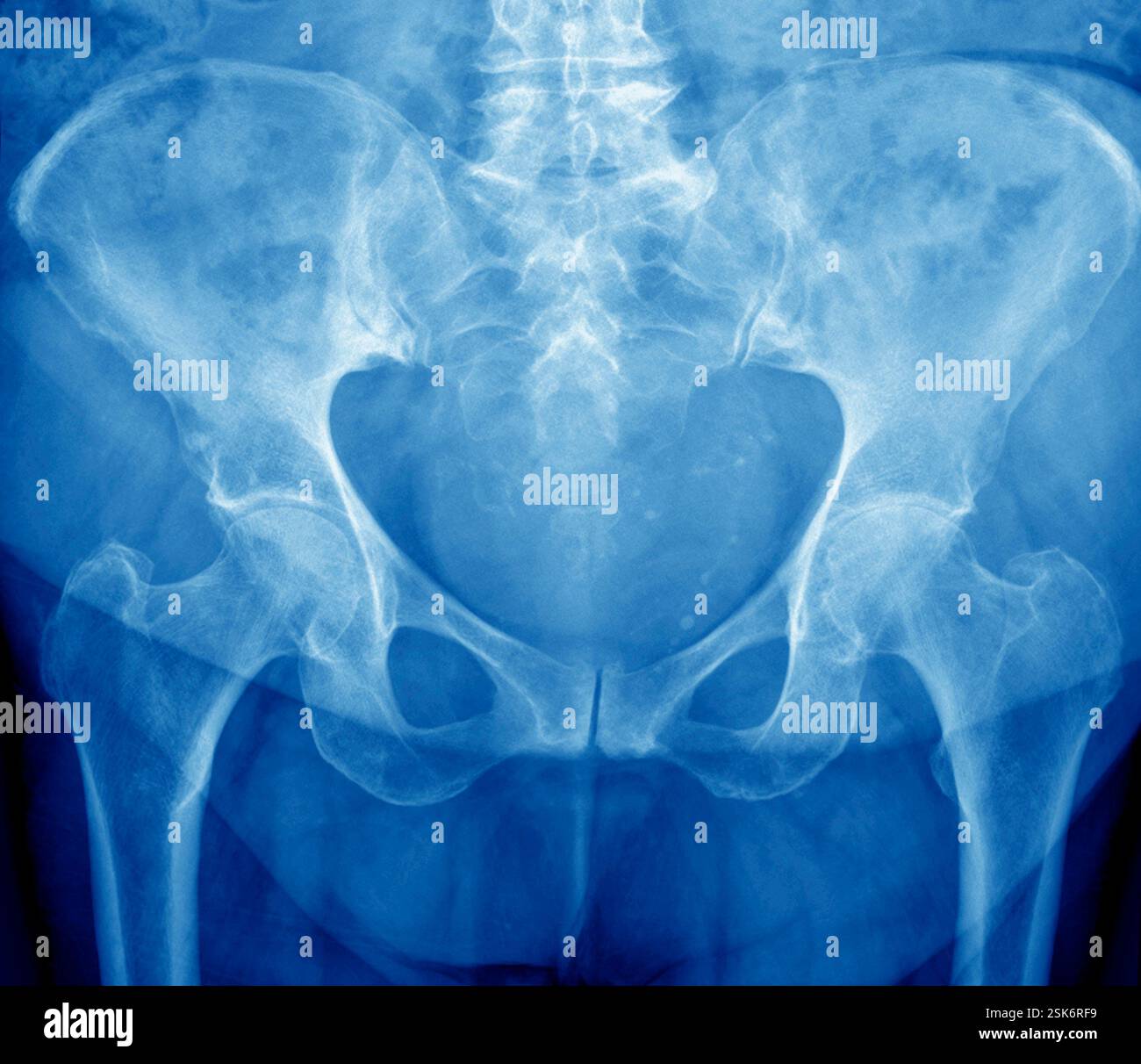 Usual interstitial pneumonia in rheumatoid arthritis, CT sca Stock ...