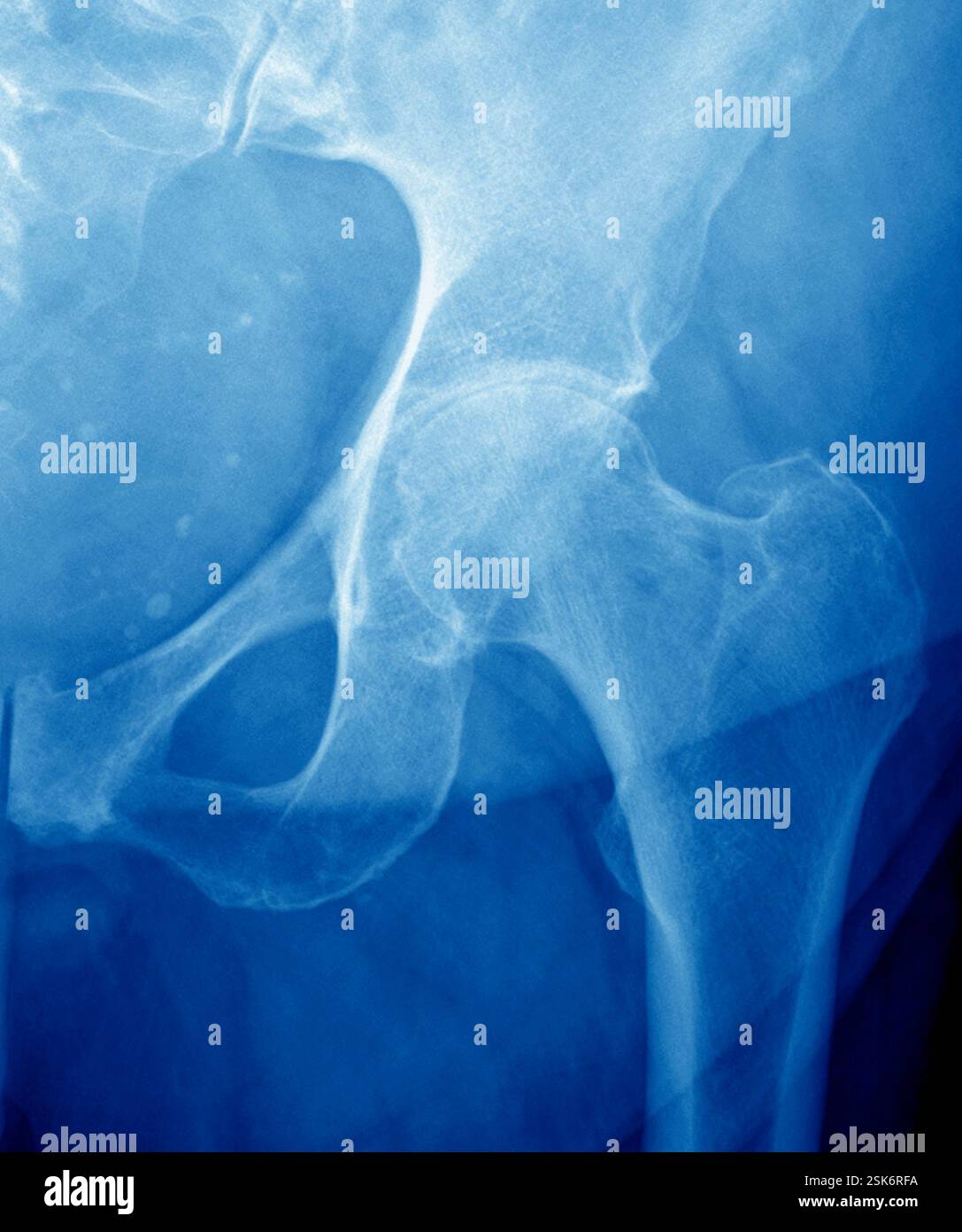 Osteoarthritis of the hip. Coloured X-ray of a section through the left ...