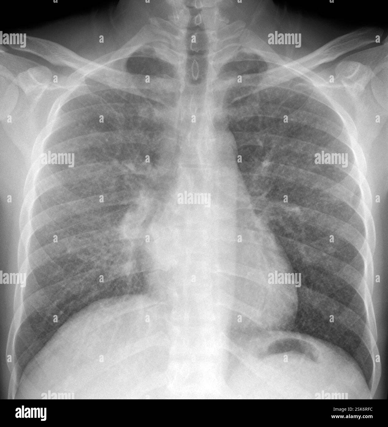 Usual interstitial pneumonia in rheumatoid arthritis, CT sca Stock ...