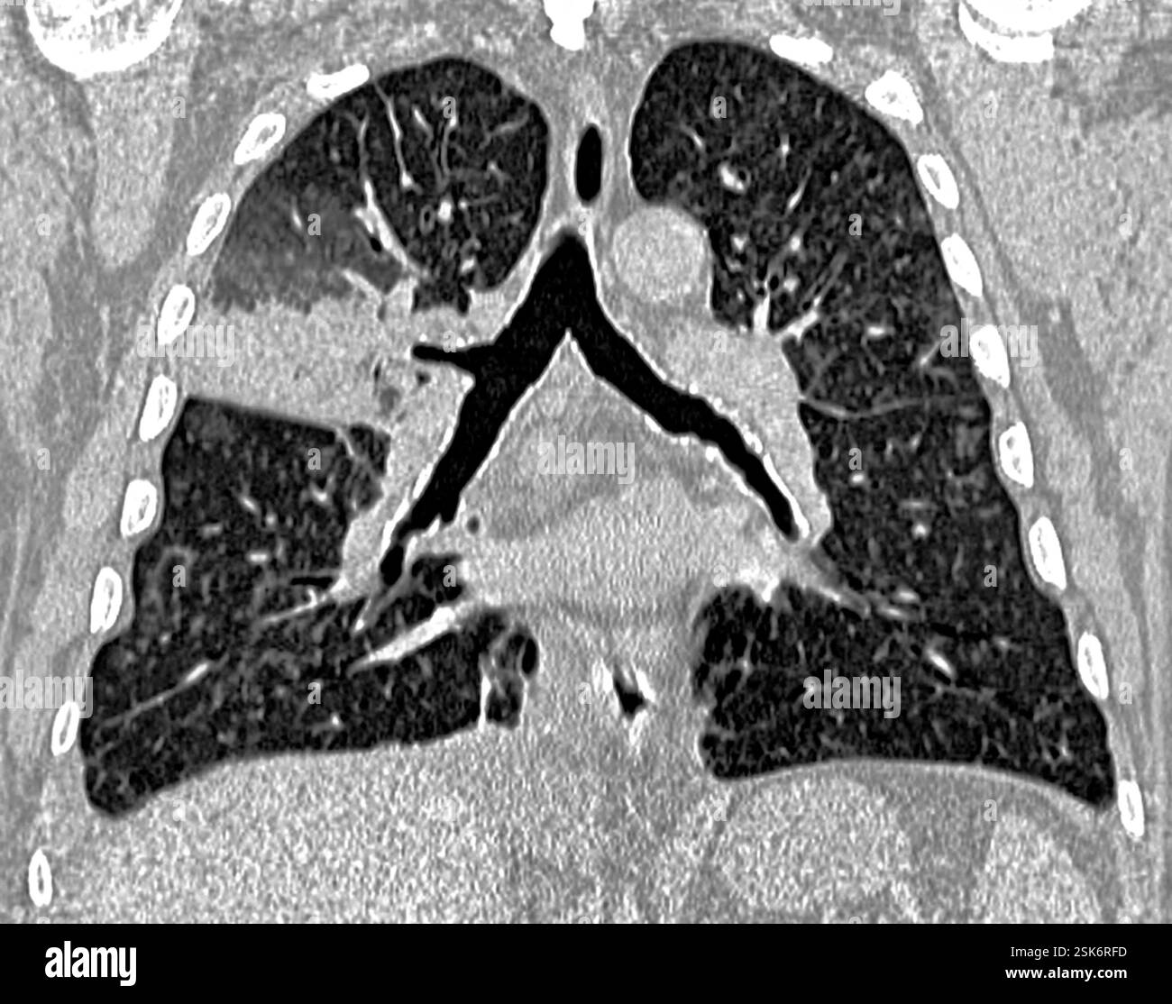 Pneumococcal pneumonia. Frontal computed tomography (CT) scan of a ...
