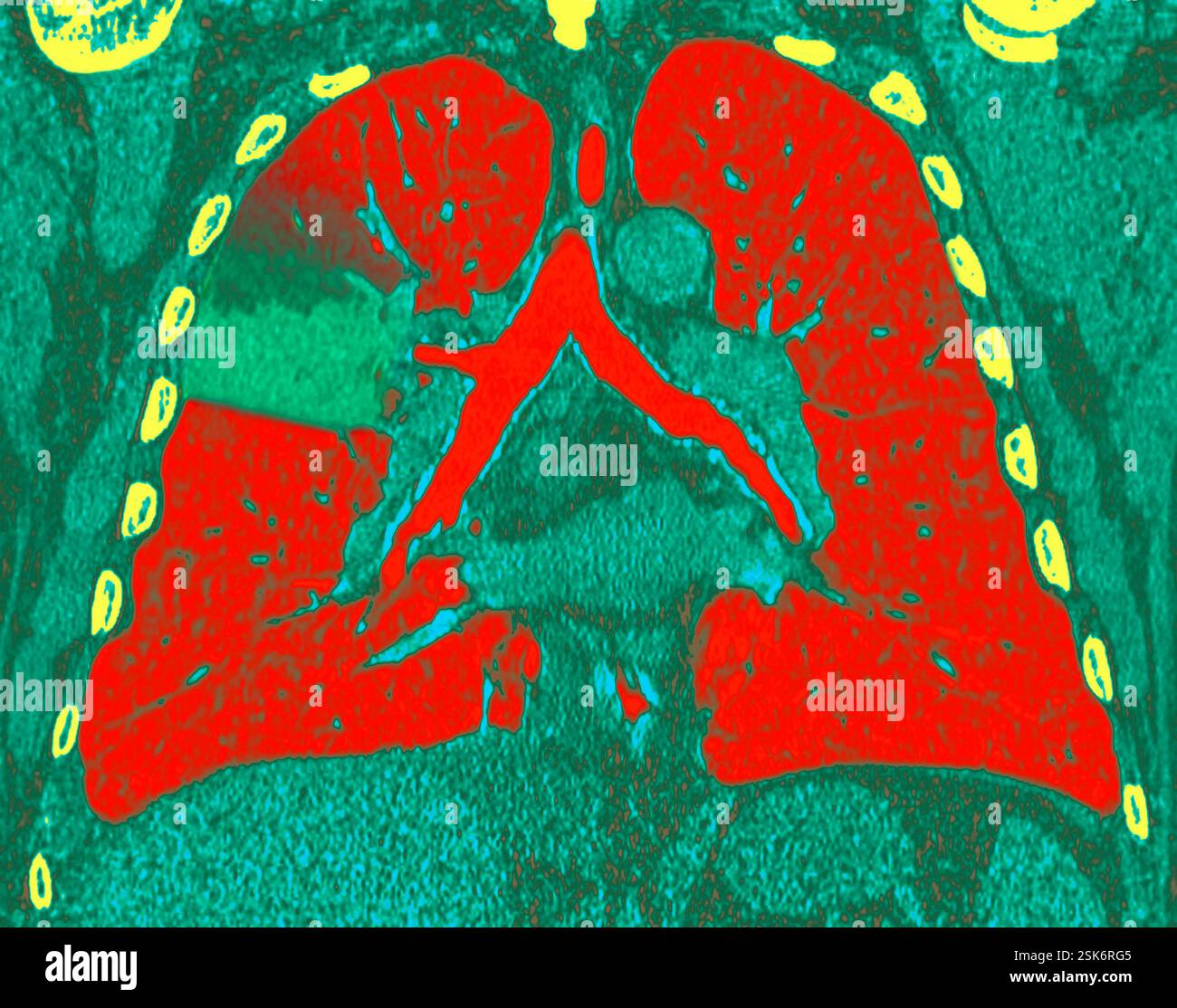 Pneumococcal pneumonia. Coloured frontal computed tomography (CT) scan ...