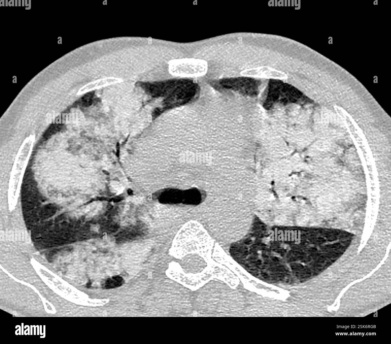 Pneumonia. Computed tomography (CT) scan of an axial section through ...