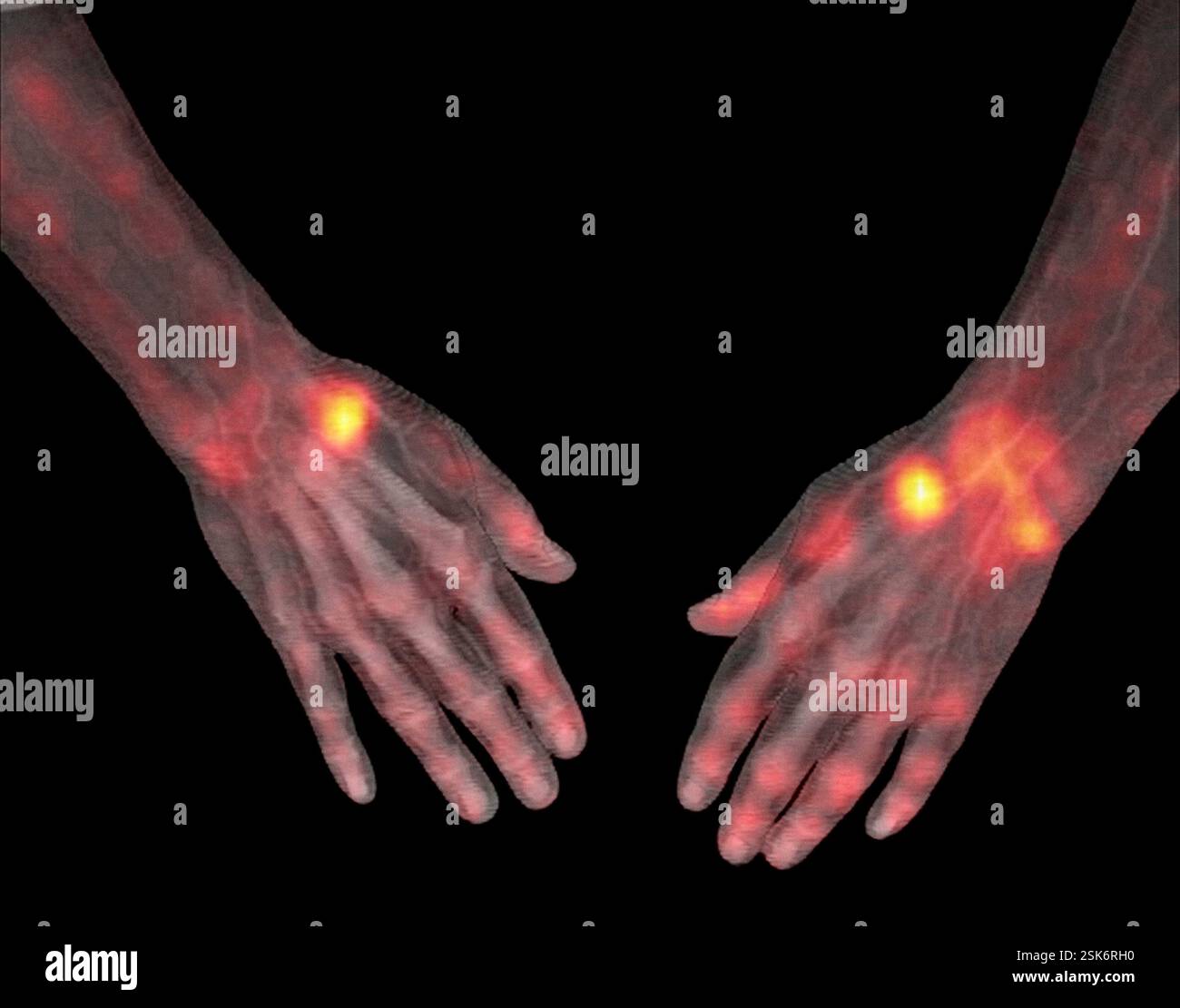 Usual interstitial pneumonia in rheumatoid arthritis, CT sca Stock ...