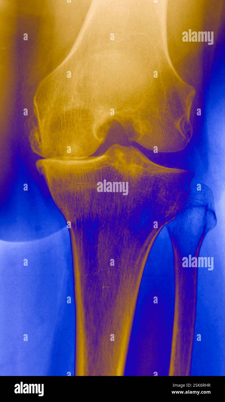 Bacterial pneumonia, coloured CT scan Stock Photo - Alamy