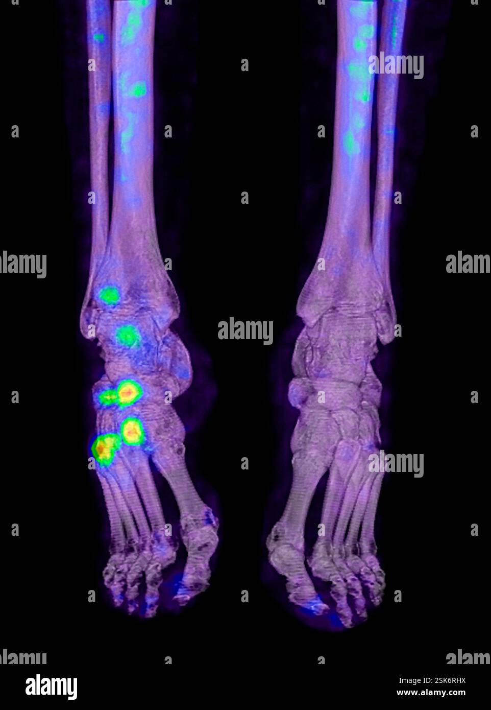 Usual interstitial pneumonia in rheumatoid arthritis, CT sca Stock ...