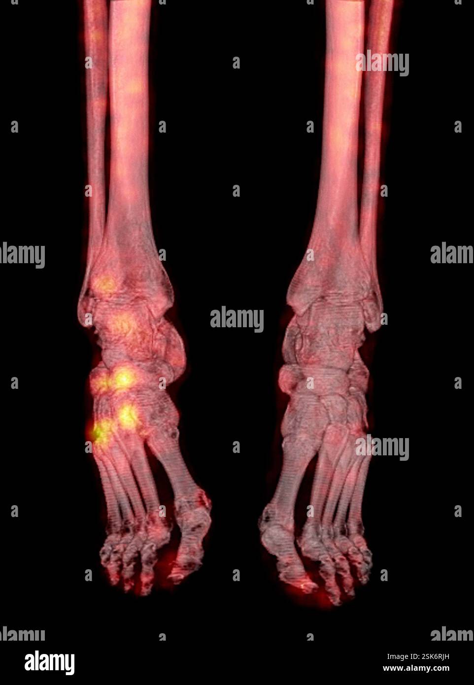 Usual interstitial pneumonia in rheumatoid arthritis, CT sca Stock ...