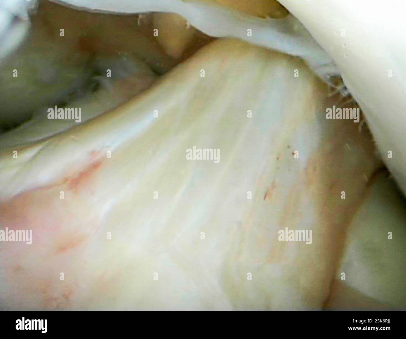 Normal ACL knee ligament. Arthroscope (endoscope) view of the healthy ...