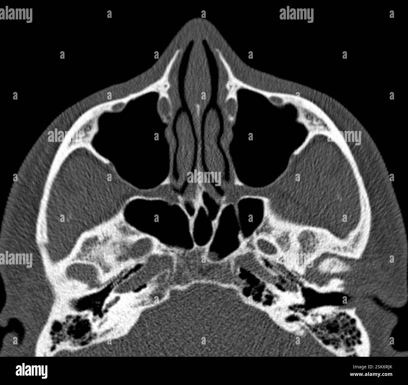 Normal sinuses. Computed tomography (CT) scan of an axial section ...