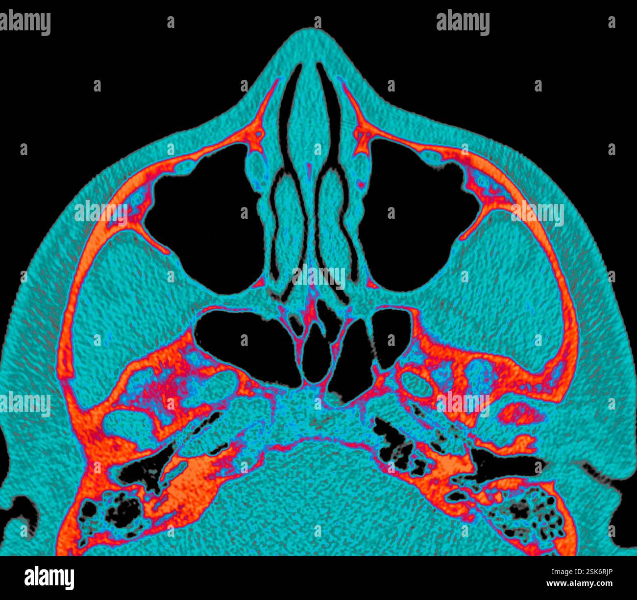 Normal sinuses. Coloured computed tomography (CT) scan of an axial ...