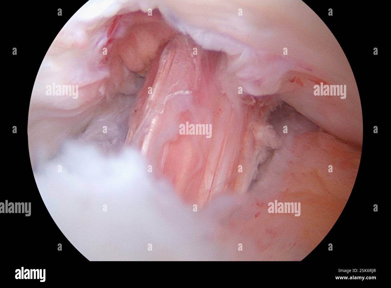 Repaired ruptured knee ligament. Arthroscope (endoscope) view of the ...