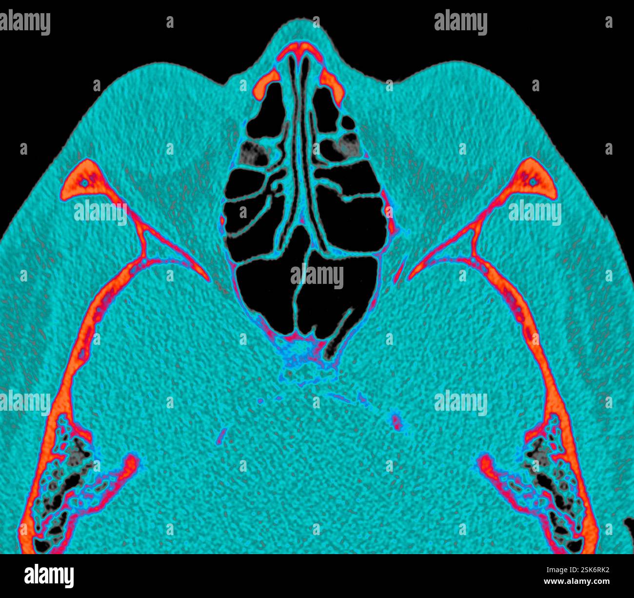 Normal Sinuses Coloured Computed Tomography Ct Scan Of An Axial Section Through The Skull