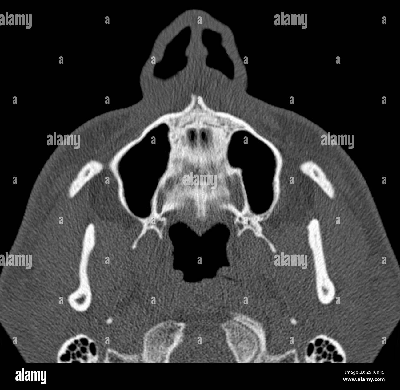 Normal sinuses. Computed tomography (CT) scan of an axial section ...