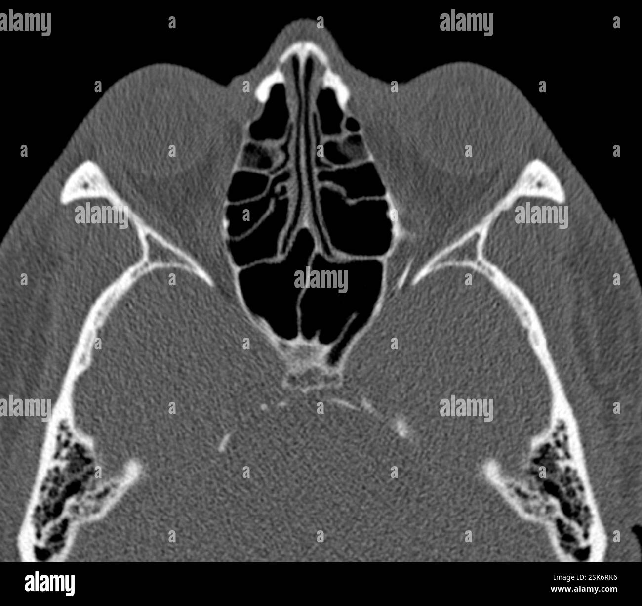 Normal sinuses. Computed tomography (CT) scan of an axial section ...