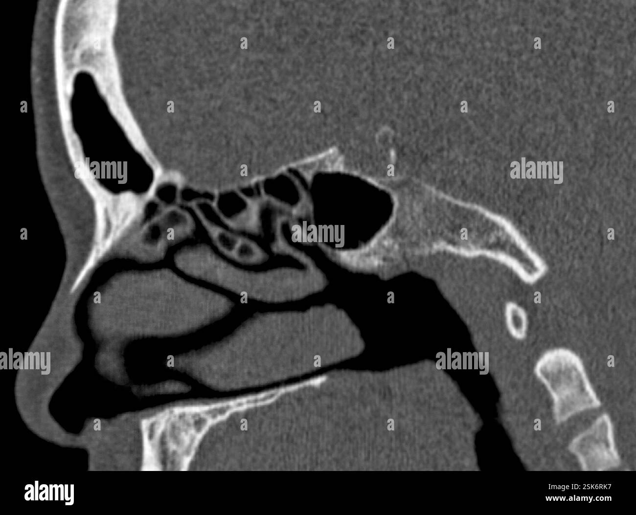 Normal sinuses. Computed tomography (CT) scan of a section through the ...