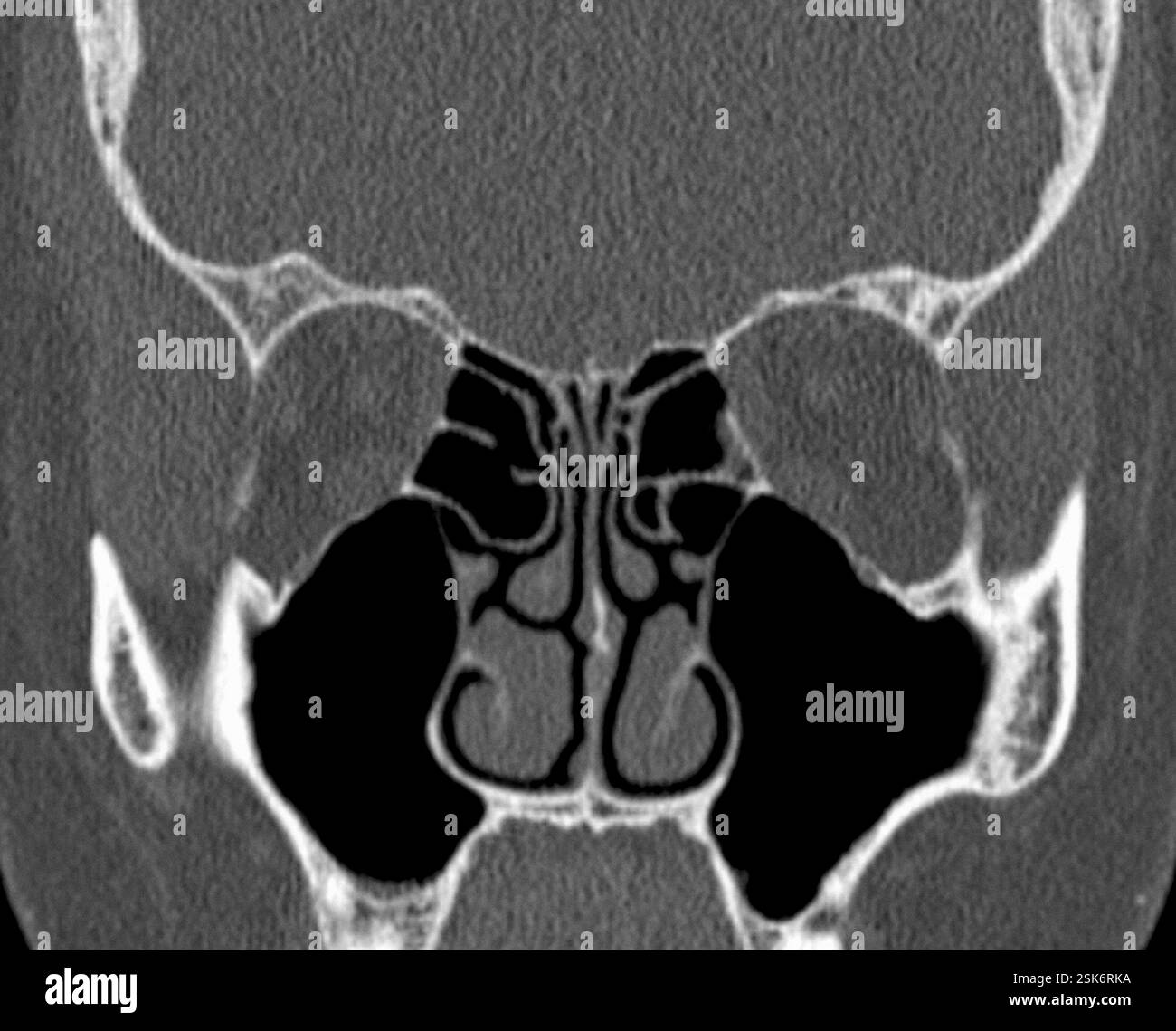 Normal sinuses. Computed tomography (CT) scan of a coronal section ...